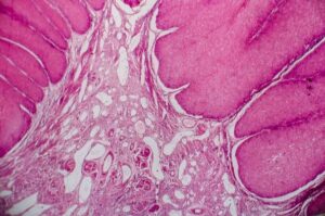 Understanding HSIL: What You Need to Know About This Precancerous ...